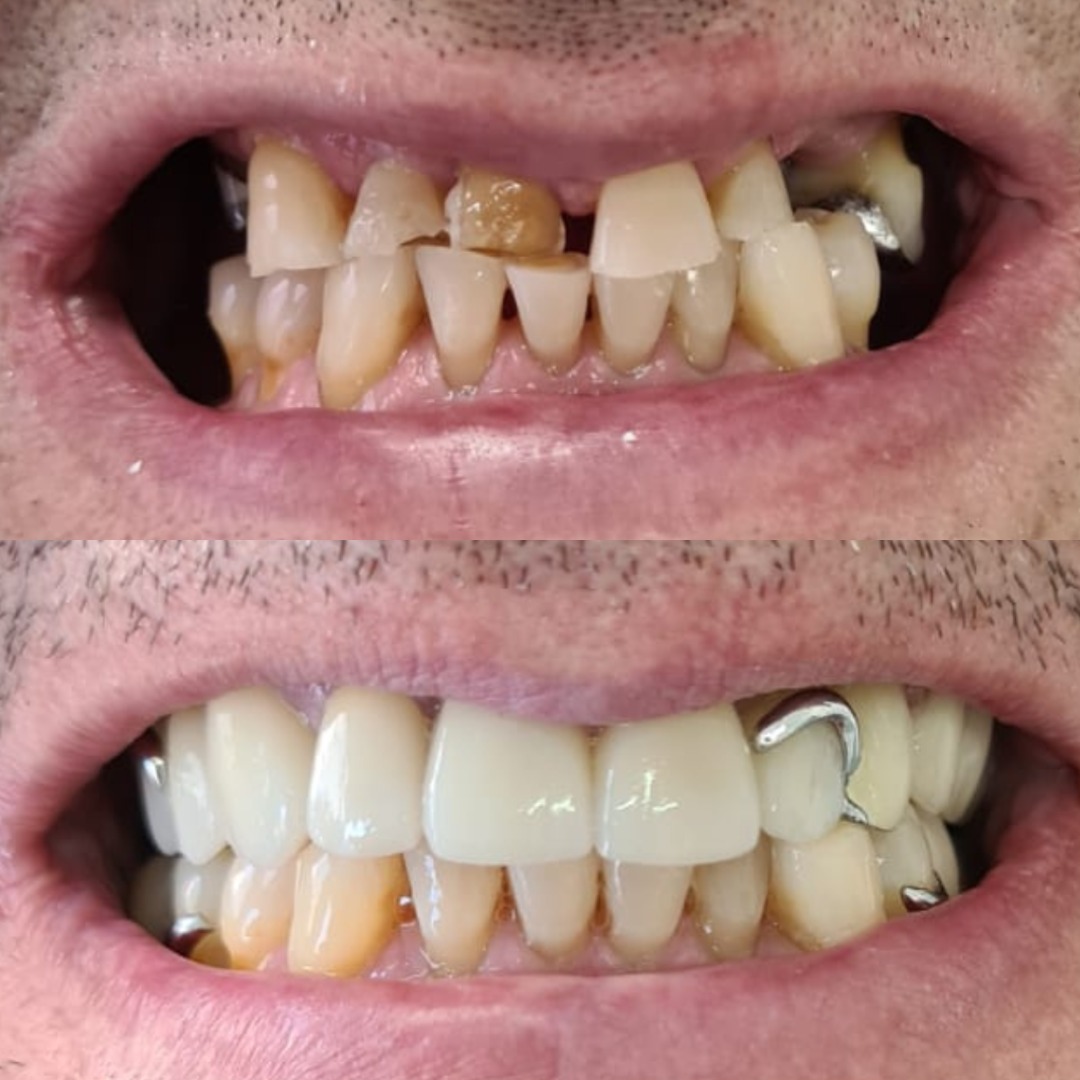 Próteses e Implantes | Sorrix Petrópolis | Odontologia 360