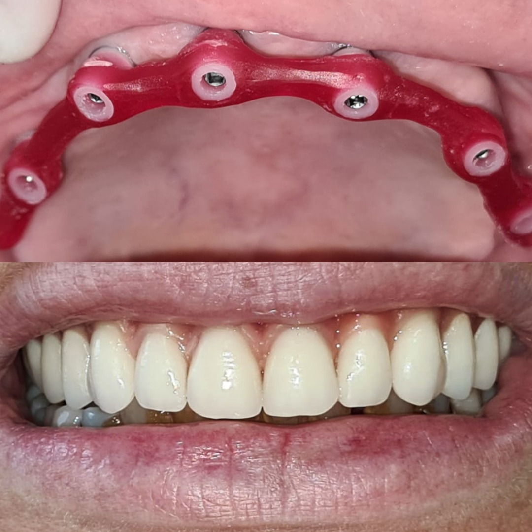 Próteses e Implantes | Sorrix Petrópolis | Odontologia 360